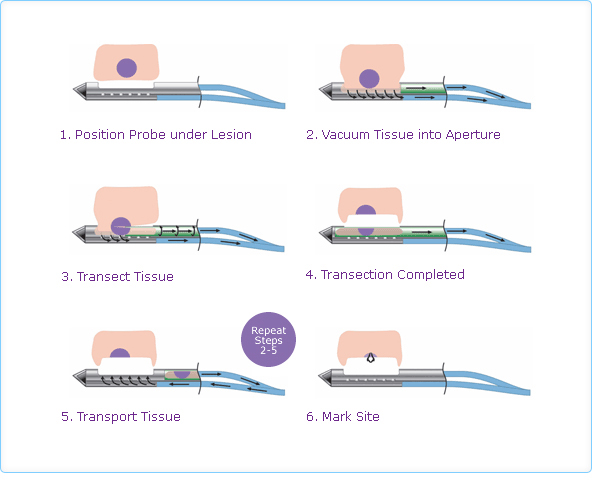 Vacuum-Assisted Biopsy (VAB): A Comprehensive Guide - Bitamed